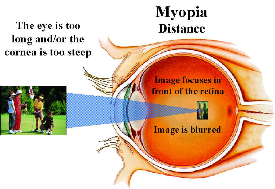 LASIK